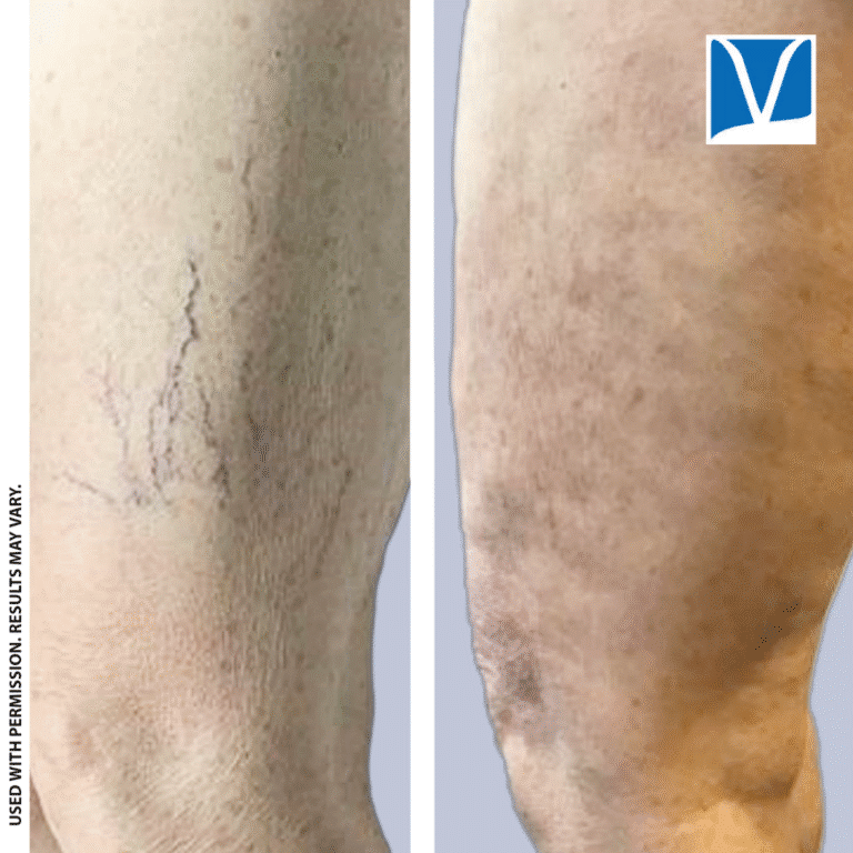 Sudden Blue Veins: Why Are My Veins So Blue?