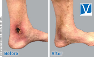 Venous Stasis Ulcer Treatment Portland OR & Vancouver WA