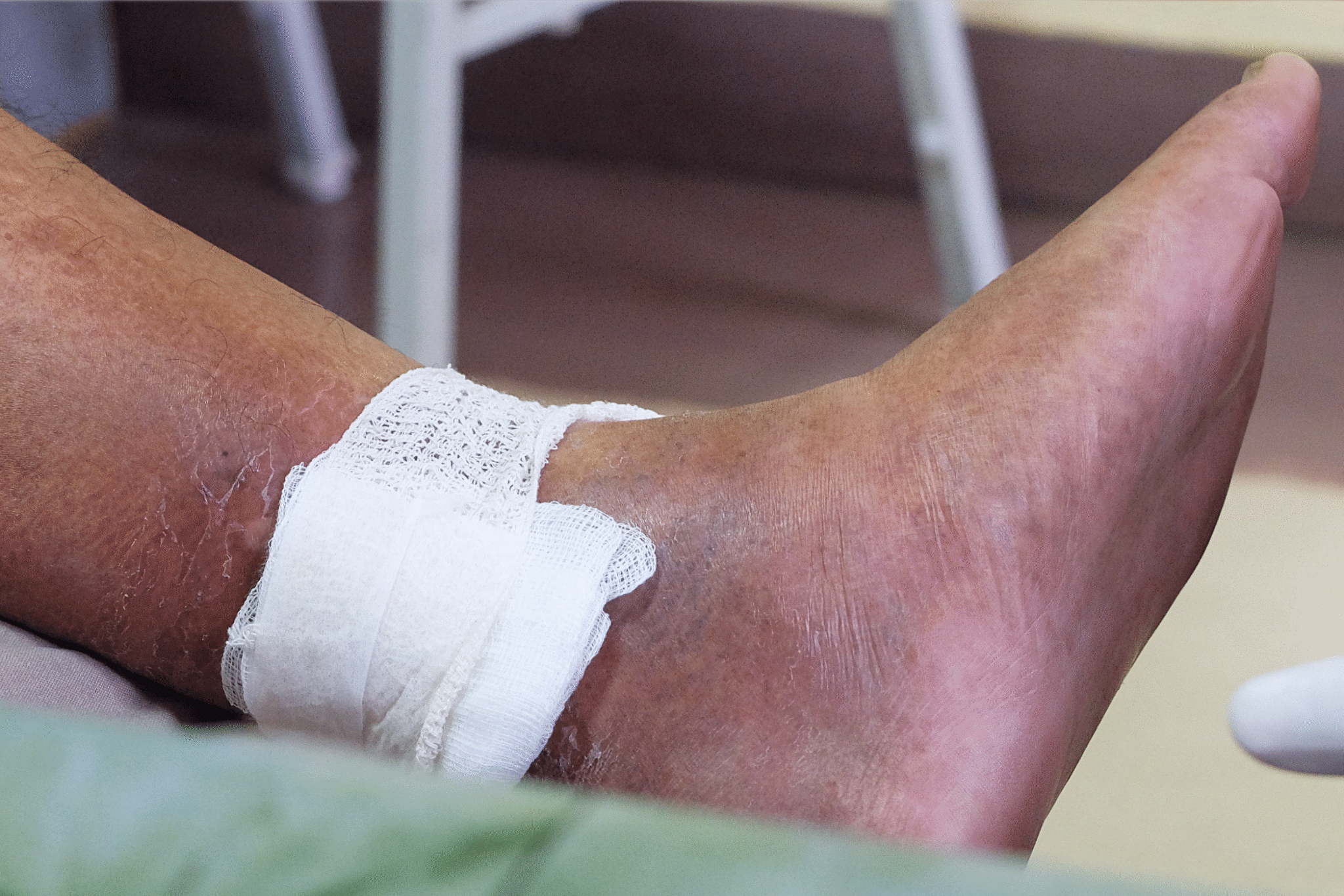 What to Do About a Venous Wound Not Healing on Lower Leg