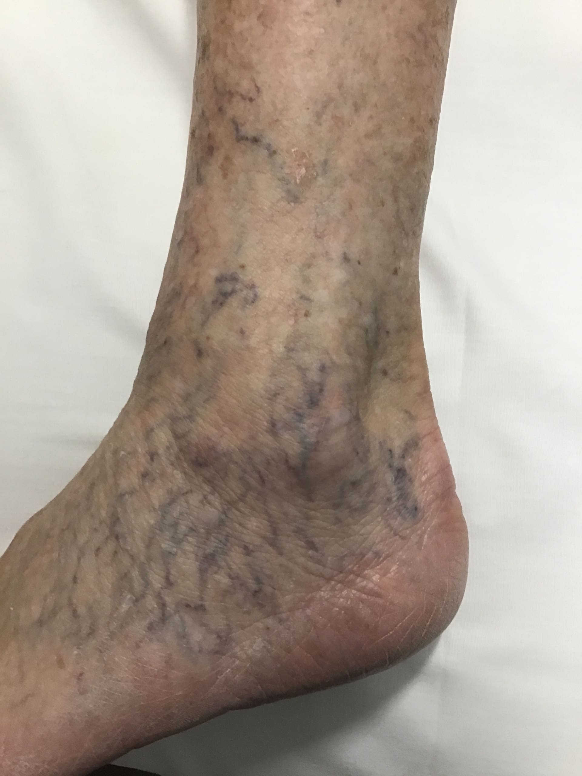 When to Worry About Spider Veins - Inovia Vein