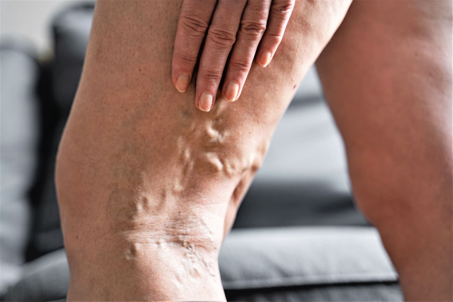 Varicose Veins Behind the Knee- Inovia Vein