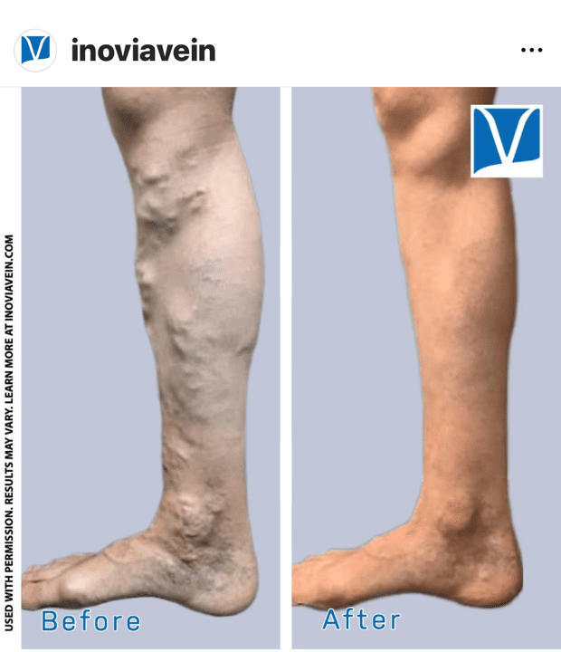 Expert Varicose Vein Treatment in Oregon - Inovia Vein Specialty Centers