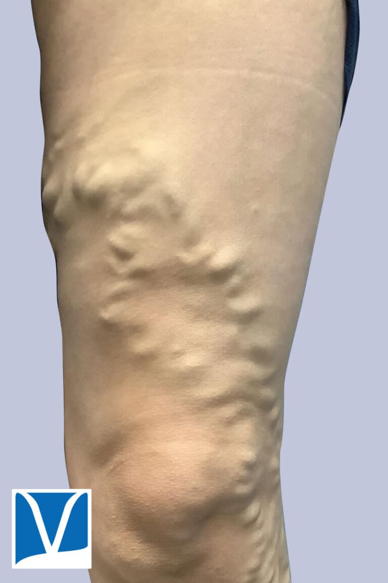 Before & After Photos of Varicose Vein Treatments