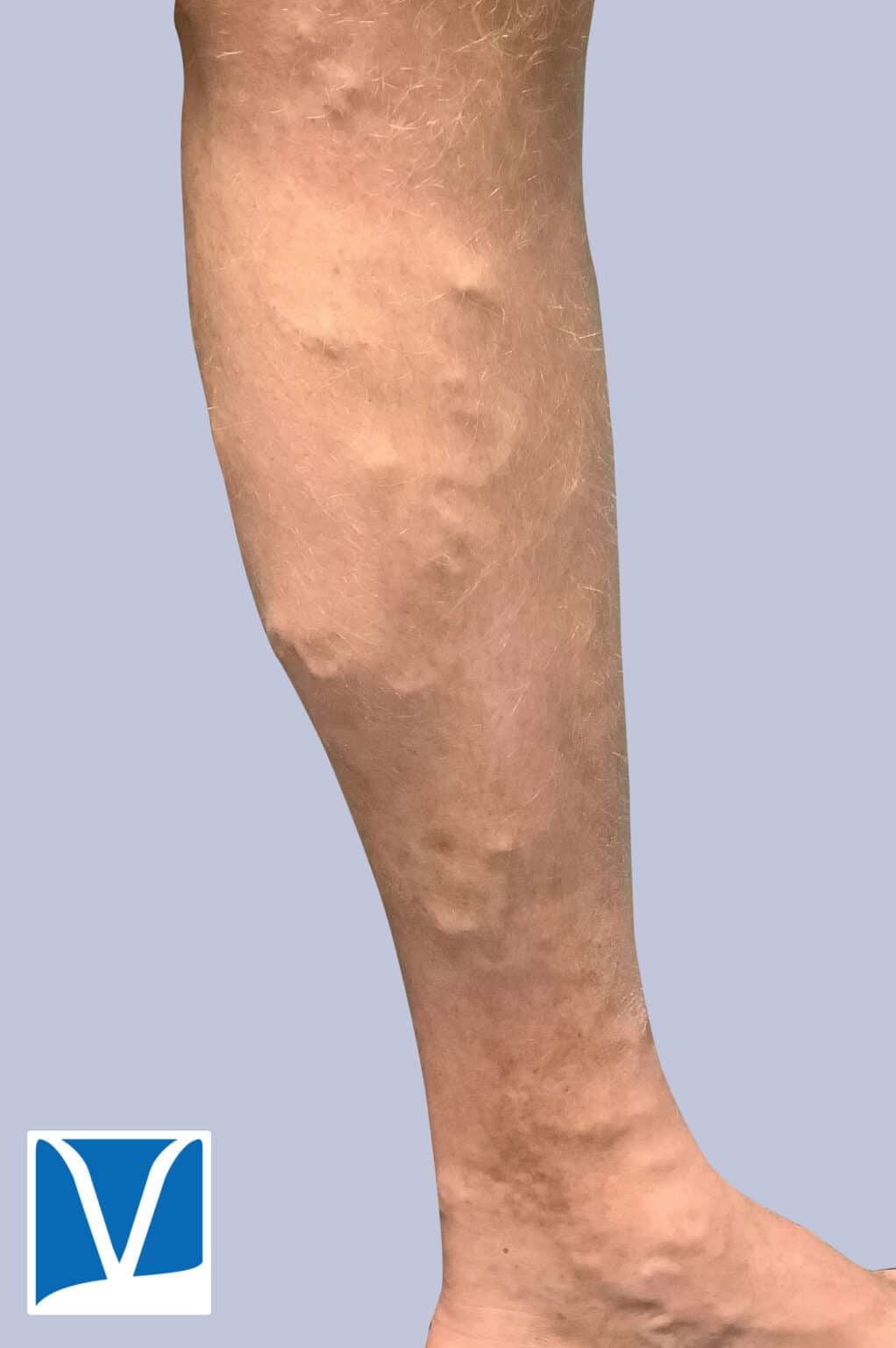 Before & After Photos of Varicose Vein Treatments